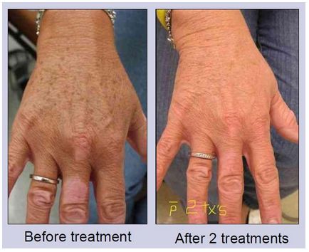 Alma Lasers SINON Lasery dermatologiczne - medipment.pl